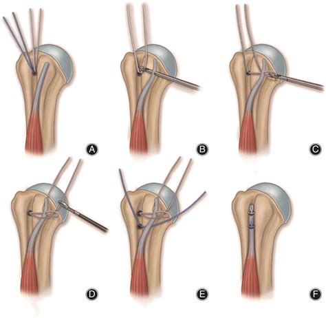 Schematic Diagram Of The Arthroscopic Modified Double‐row Biceps Download Scientific Diagram