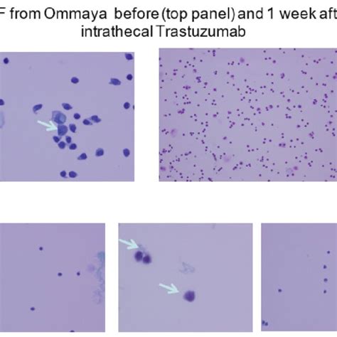 Top Panel Demonstrates Csf Findings With Numerous Malignant Cells