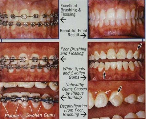 Braces Instructions Smiles And Faces Orthodontics Blacktown