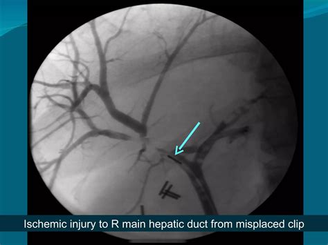 Endoscopy In Gastrointestinal Oncology Slide 12 J Baillie Distinguishing Benign From
