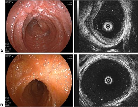 Evaluation Of Deep Remission With Through The Scope Catheter Based Eus