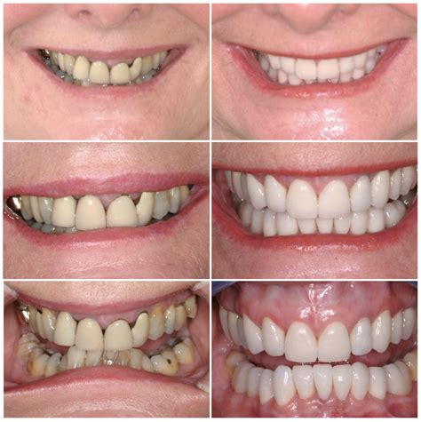 Deep Bite Treatment Advanced Dentistry