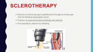 Esophageal Varices Ppsx