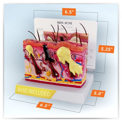 Skin Acne Cross Section Model Gpi 3d Anatomy