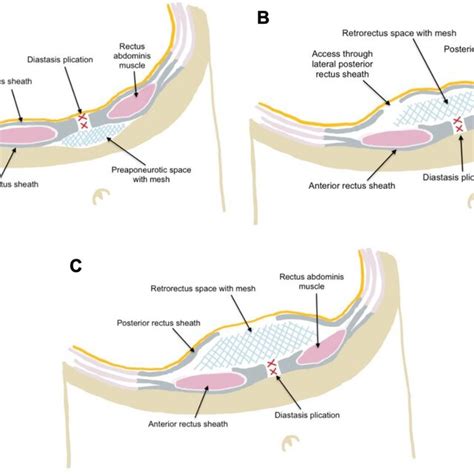 Schematic Representation Of The Minimally Invasive Surgical Approaches