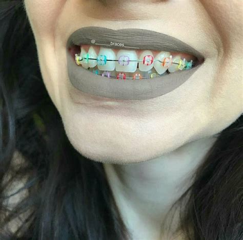 Pin By Melissa Mb On Brackets Cute Braces Braces Colors Cute Braces
