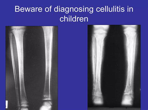 Bone And Joint Infect Ppt