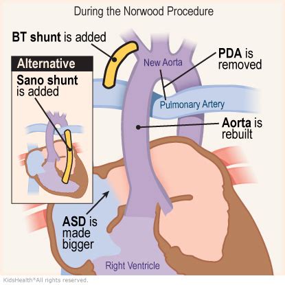 Norwood Procedure