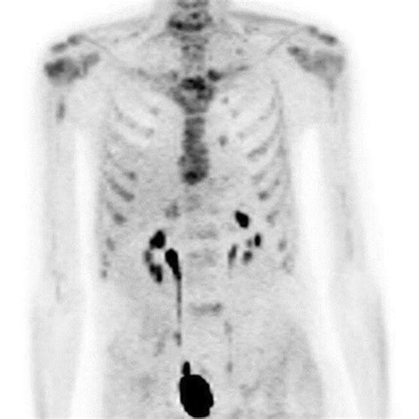 A Maximum Intensity Projection Image Of A 18 F Fdg Petct Study