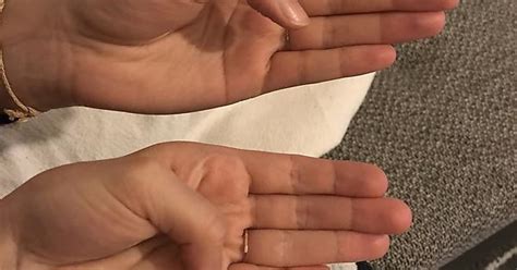 My Friend Top Hand Can Only Use One Of The Joints Of Her Thumb