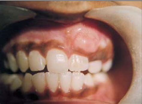Swelling Seen On The Left Side Of Face Download Scientific Diagram