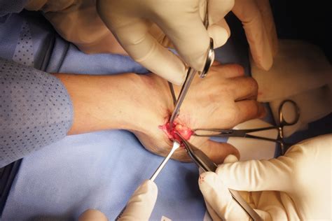 Nerve Repair Surgery In Hyderabad Akruti