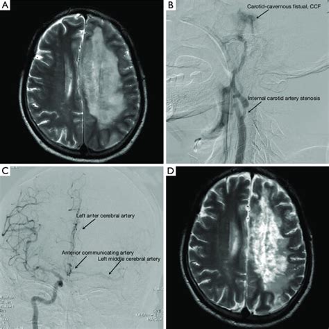 The Imaging Data Of Case 1 A Head Mri Showing Left Frontal And