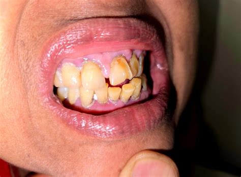 Was Gingival Hypertrophy Induced By Vildagliptin Cme India