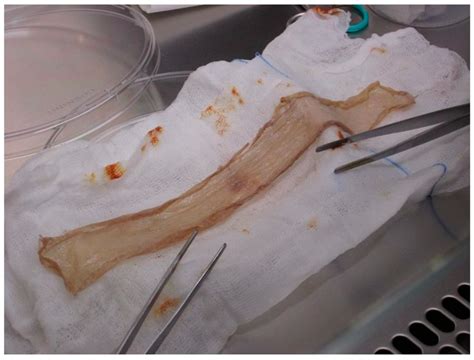 A Skin Allograft Thickness Between 04 And 06 Mm In Processing At