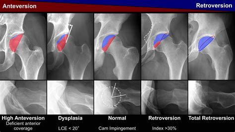 S Steppacher Pelvic Incidence In Acetabular Retroversion Hip