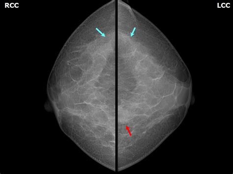 Atlas Of Breast Cancer Early Detection