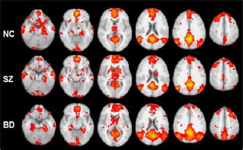 Mri And Medical Imaging Fmri Of Brain At Rest Reveals Early Signs Of Alzheimers