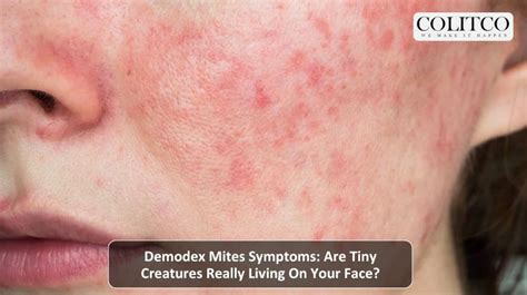 Tiny Face Mites The Truth About Demodex Mites Symptoms