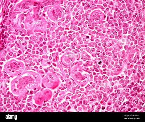 Myeloid Sarcoma Light Micrograph Of A Diffuse Infiltrate Of Medium To