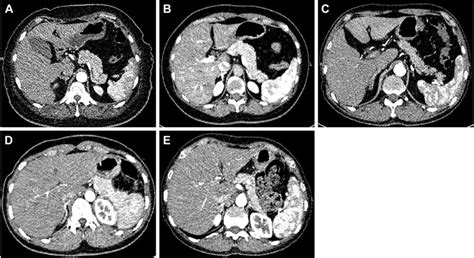 Representative Perfusion Ct “arterial Phase” 20 S After Perfusion Scan