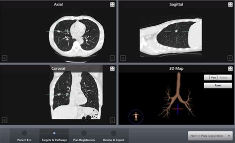 Electromagnetic Navigational Bronchoscopy For Peripheral Pulmonary Nodules Thoracic Surgery
