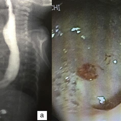 A Egd Study Showing The Dilation Of The Body Of The Esophagus And A