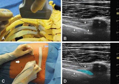 Ultrasound Guided Thoracic Paravertebral Block Sonosif By Sifsof