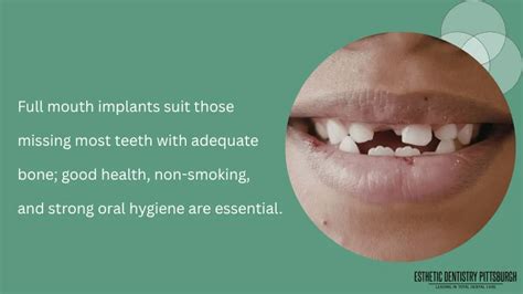 Full Mouth Dental Implant Recovery Time Timeline And Healing Stages