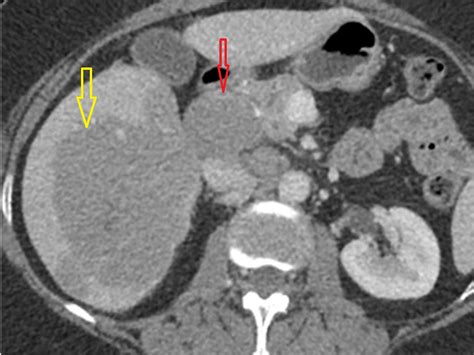 Porta Hepatis Lymph Node