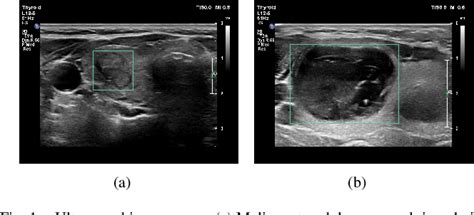 Figure 1 From Thyroid Nodule Classification In Ultrasound Videos By