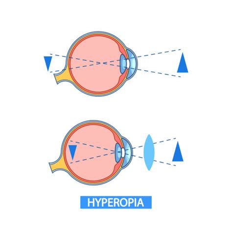 400 Eye Refraction Test Ilustração De Stock Gráficos Vetoriais E
