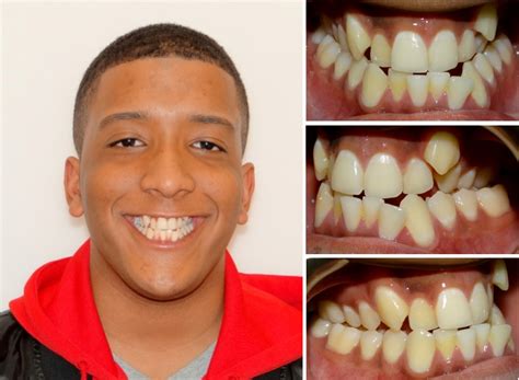 How Long To Correct A Crossbite Dhsfk