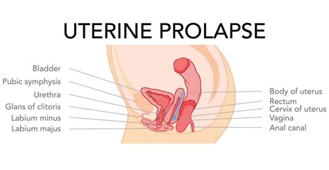 Pelvic Organ Prolapse Repair Urogynecologist Pelvic Reconstruction