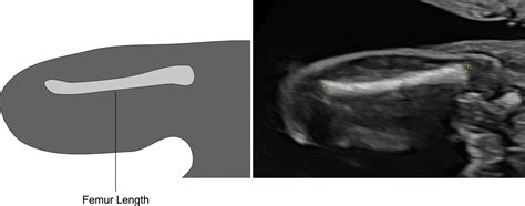 Ultrasound Diagnosis Of The Small And Large Fetus Obstetrics And