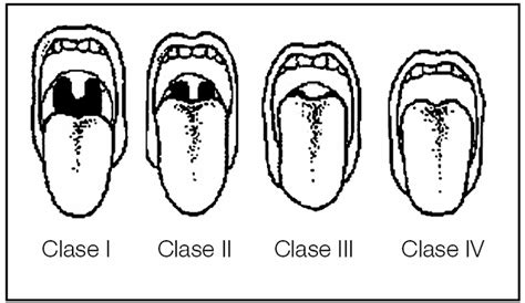 Memorias De Un Residente Edema De Úvula