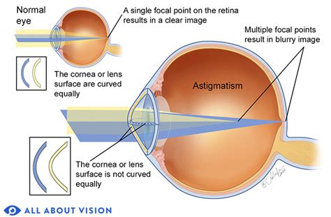 Astigmatism Cornea Eye Diagram