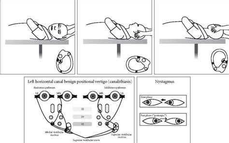 Benign Paroxysmal Positional Vertigo Bbpv Ears In Balance Chelsea