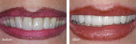 Smile Gallery Asheville Asheville Nc John Highsmith Dds