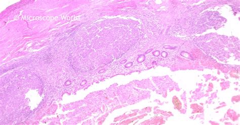 Microscope World Blog Acute Suppurative Appendicitis Under The Microscope