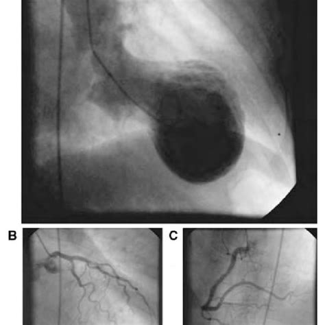 Left Ventriculography In A Patient With Stress Induced Cardiomyopathy