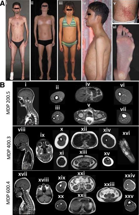 Fat Distribution Patterns