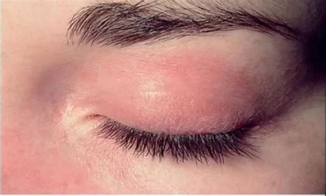 再谈儿童的系统性红斑狼疮 知乎