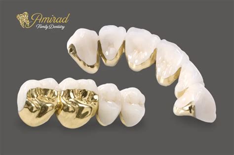 Pfm Crown Or Porcelain Fused To Metal Crowns Full Guide
