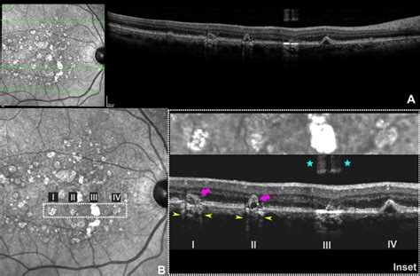 Distinguishing Nir And Oct Findings Of Hcds And Refractile Drusen A Download Scientific