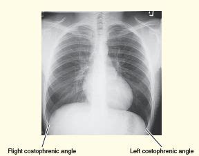 Costophrenic Angle