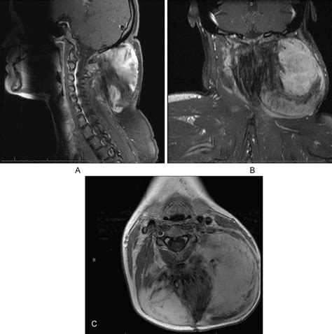 Desmoid Tumor Recurrence