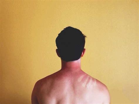 How Long Does Windburn Lips Last