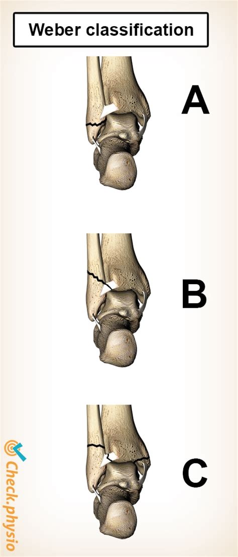 Ankle Fracture Physio Check