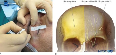 Regional Anesthesia Supraorbital And Supratrochlear Nerve Block Sensory Area Of The Supraorbital